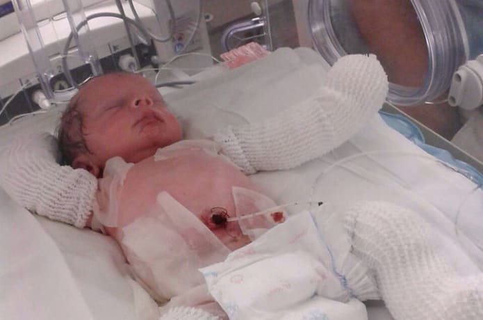 Help Save Easton- baby battling Epidermolysis Bullosa- EB | Indiegogo