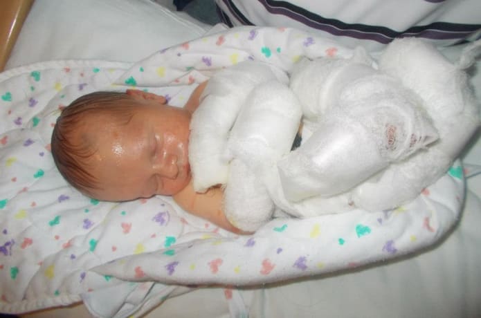 Help for Eli - a sweet baby battling Epidermolysis Bullosa | Indiegogo